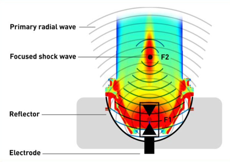 Electrohydraulic Shock Wave Generation - CMT Medical